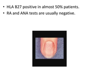 Seronegative Arthropathy.pptx