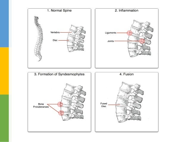 Seronegative spondyloarthropathies