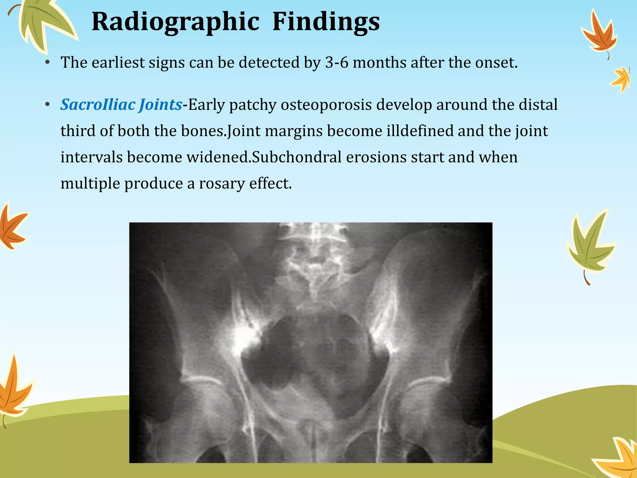 Seronegative Spondyloarthropathies | PPTX
