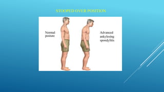 Seronegative spondyloarthropathies | PPTX