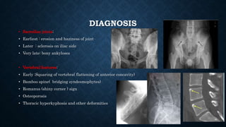 seronegative spondyloarthropaty.pptx