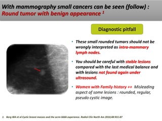 Jean Yves Seror : Breast cancer : Small lesion imaging features | PDF