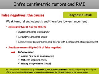 Jean Yves Seror : Breast cancer : Small lesion imaging features | PDF