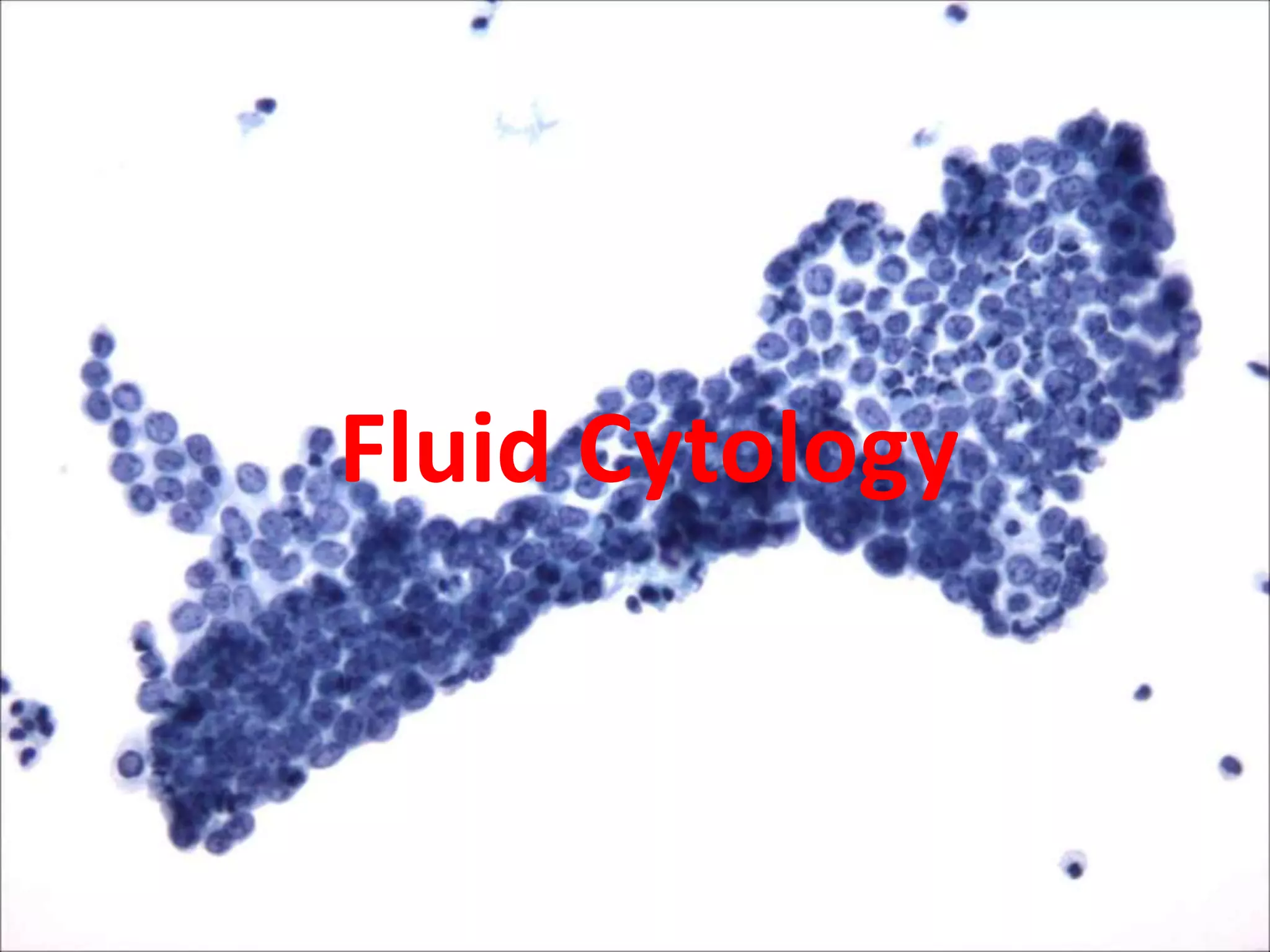 Fluid Cytology In Serous Cavity Effusions Pptx