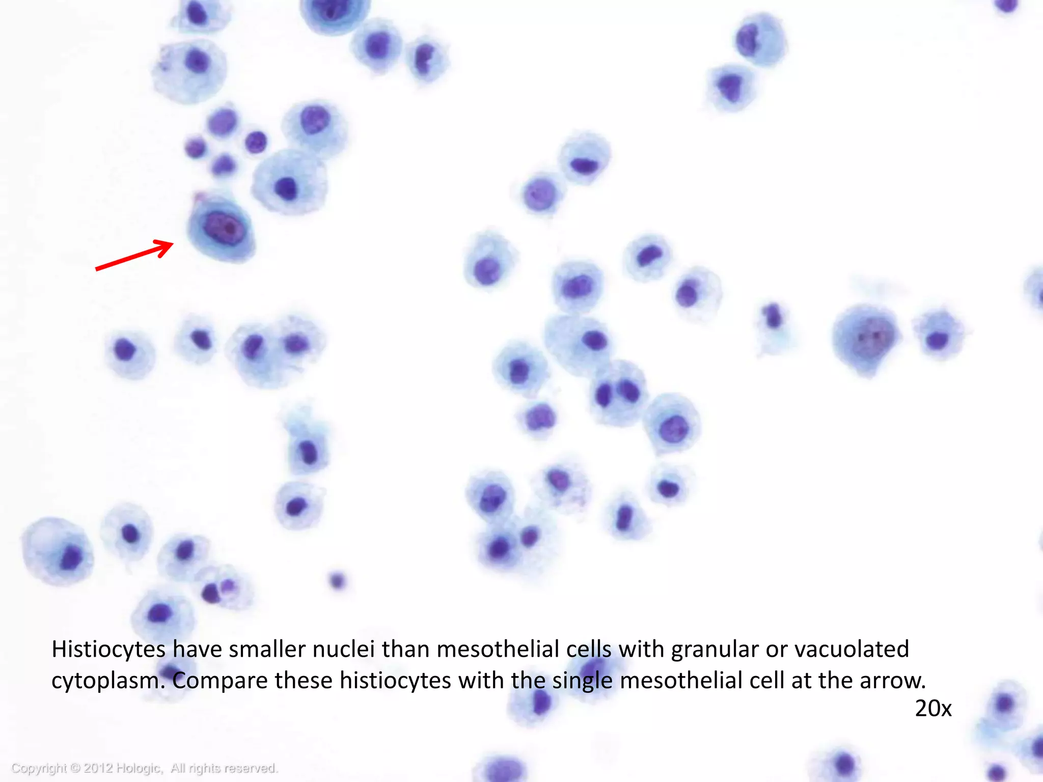 Fluid cytology in serous cavity effusions | PPTX