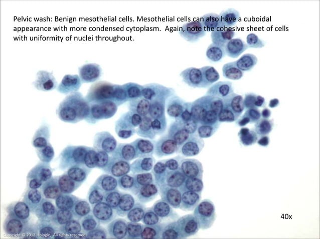 Fluid cytology in serous cavity effusions | PPT
