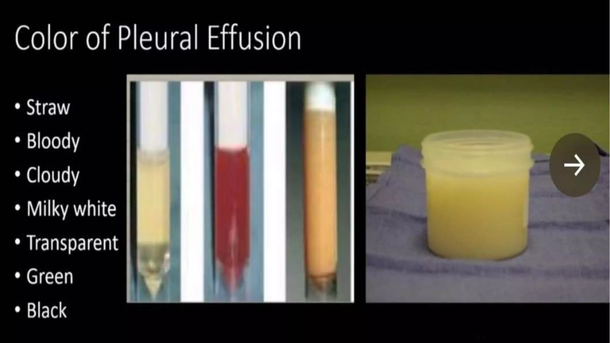 serous fluid Dr shweta [Autosaved].pptx