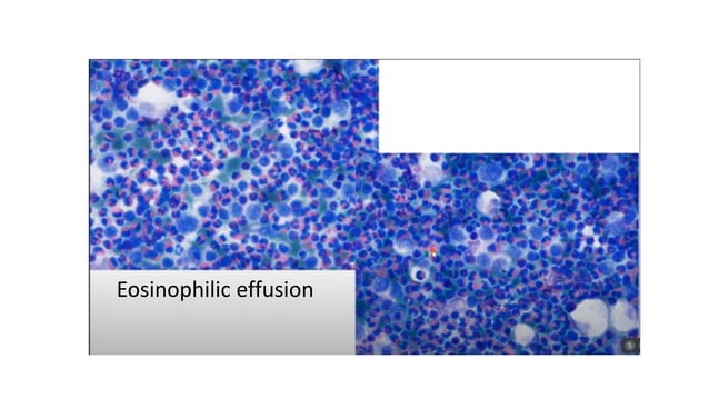 serous fluid Dr shweta [Autosaved].pptx | Lung and Respiratory Health ...