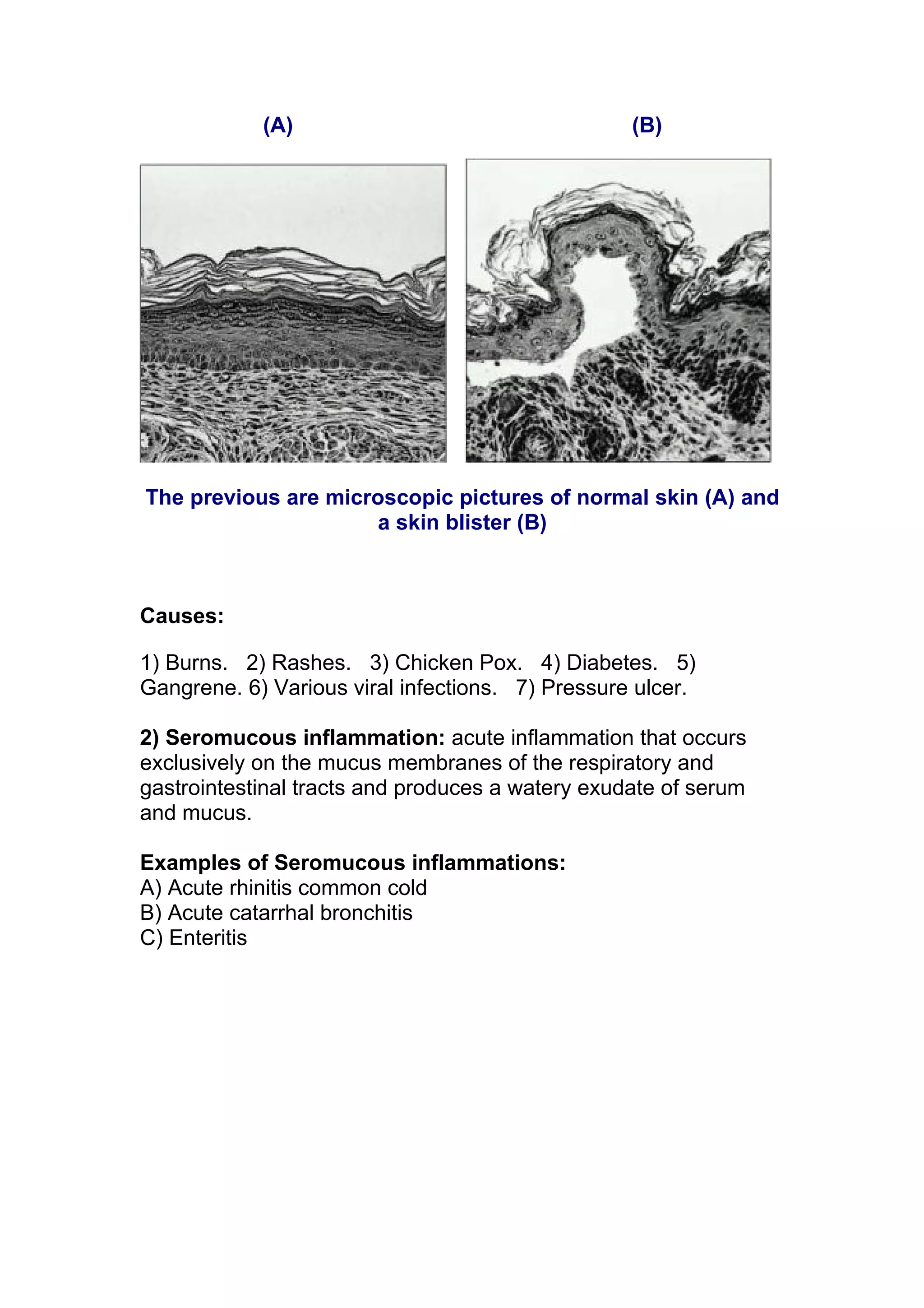 Serous Inflammation | DOC