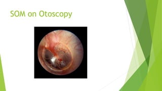 Serous otitis media | PPTX