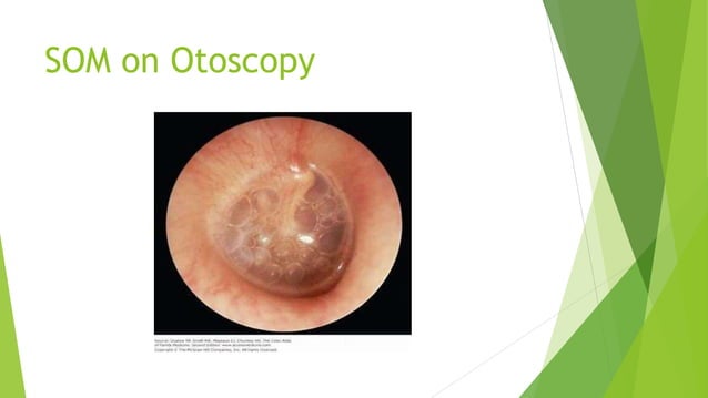 Serous otitis media | PPTX