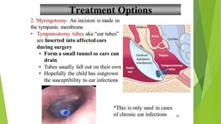 Serous otitis media | PPTX