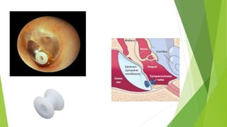 Serous otitis media | PPTX