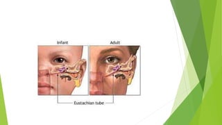 Serous otitis media | PPTX