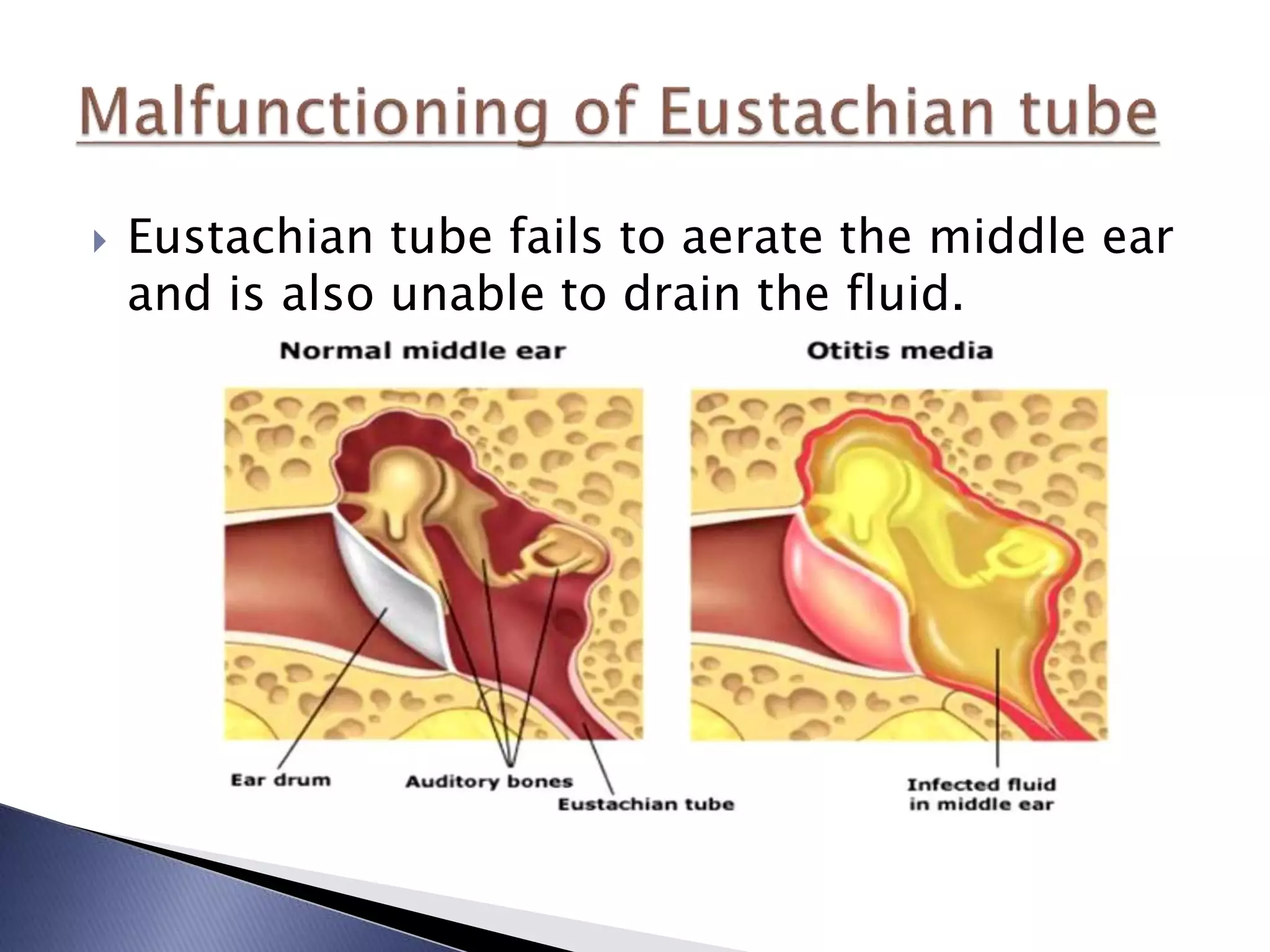 SEROUS OTITIS MEDIA.final.pptx