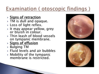 SEROUS OTITIS MEDIA.final.pptx