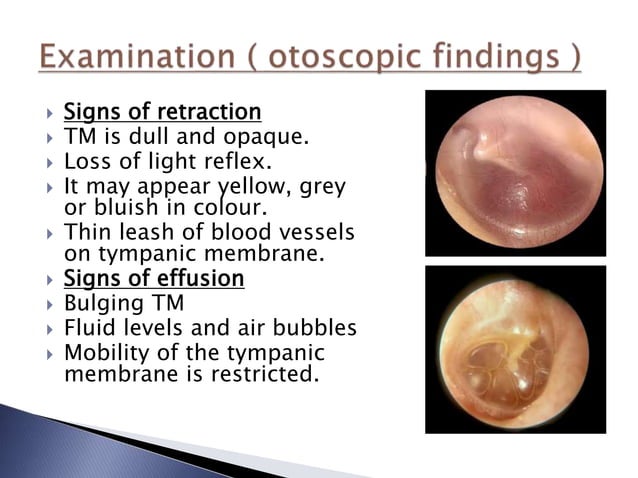 SEROUS OTITIS MEDIA.final.pptx | Ear, Nose and Throat Conditions ...