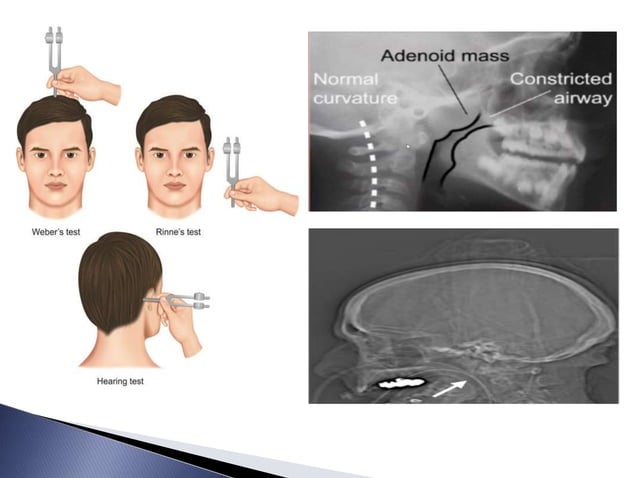SEROUS OTITIS MEDIA.final.pptx | Ear, Nose and Throat Conditions ...