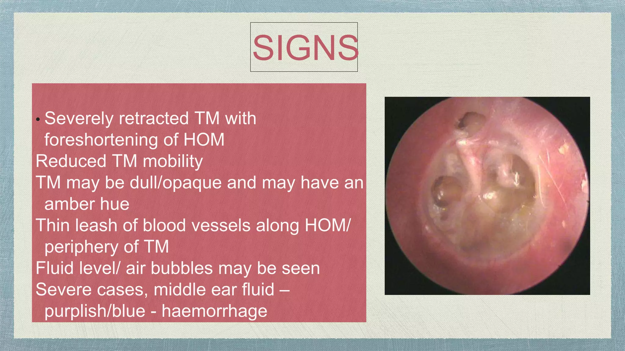 Serous Otitis Media (SOM) | PPTX