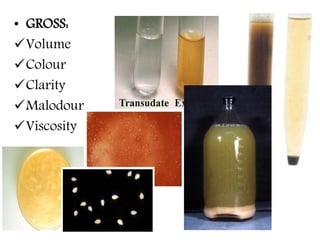 Serosanguinous Fluid