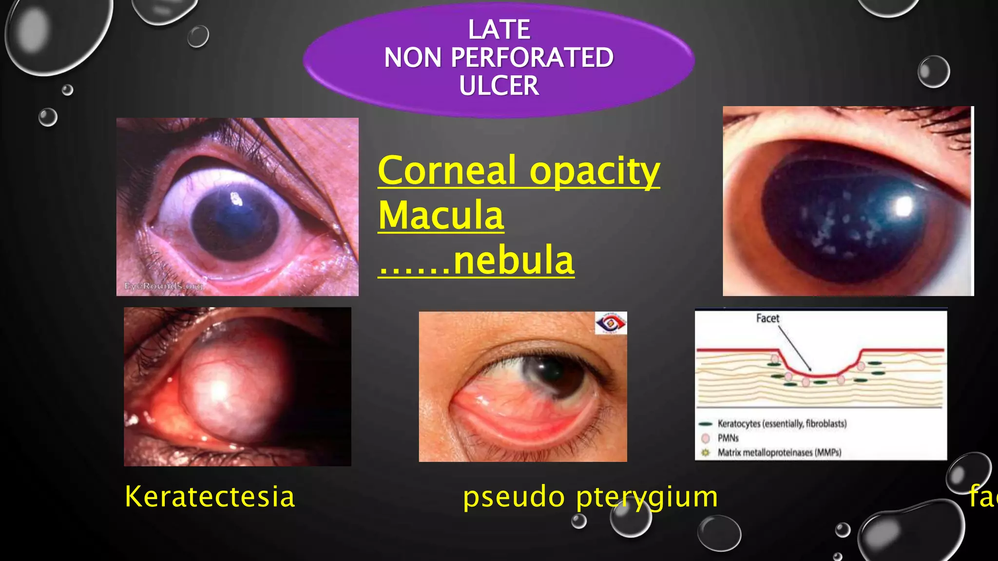 Serpiginous corneal ulcers | PPTX