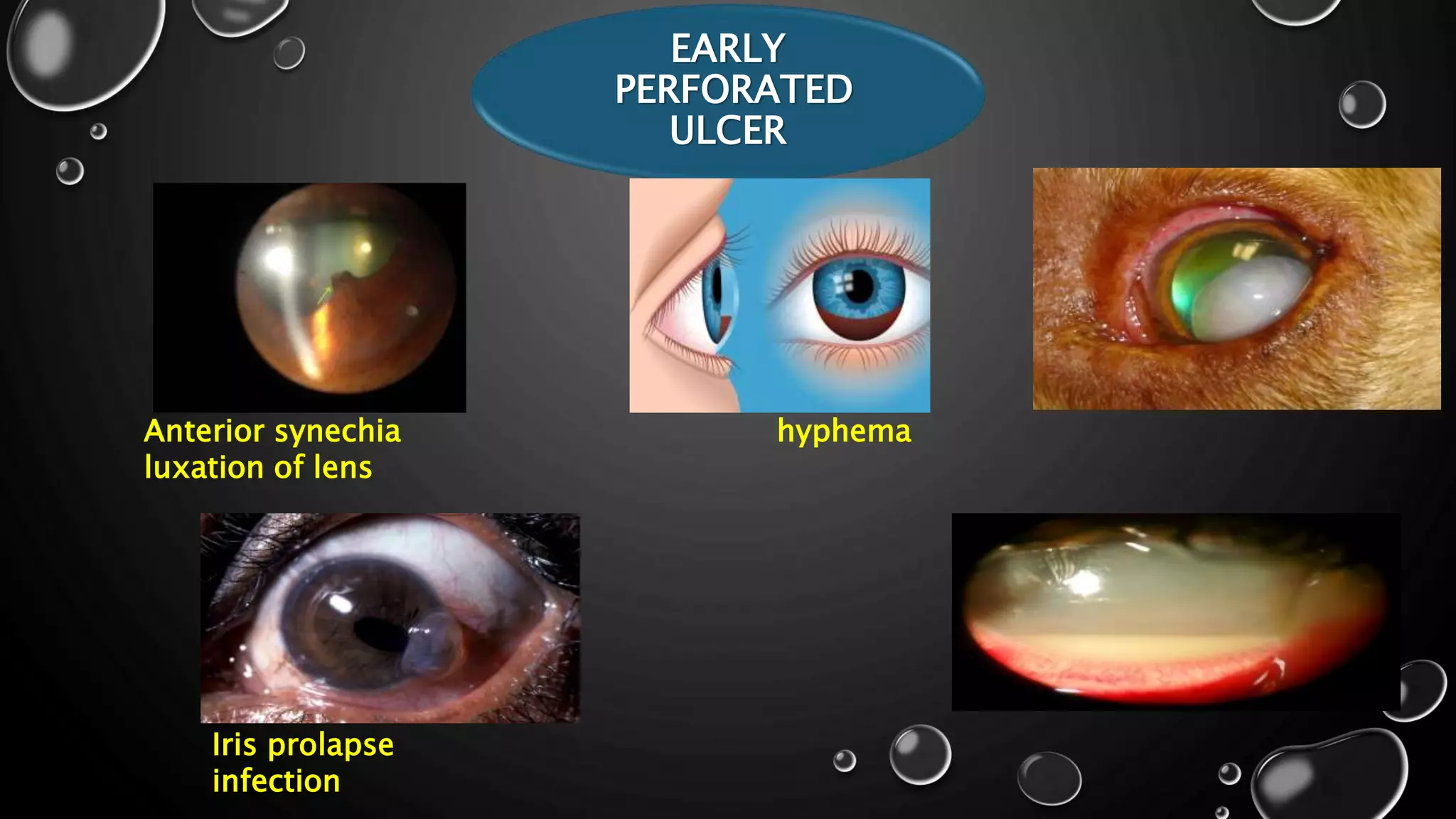 Serpiginous corneal ulcers | PPTX