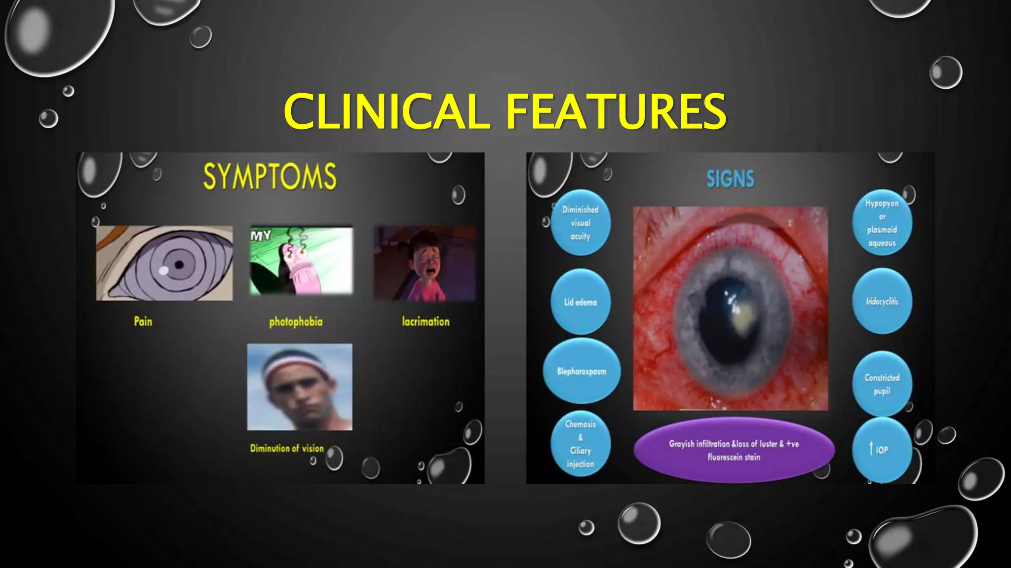 Serpiginous corneal ulcers | PPTX