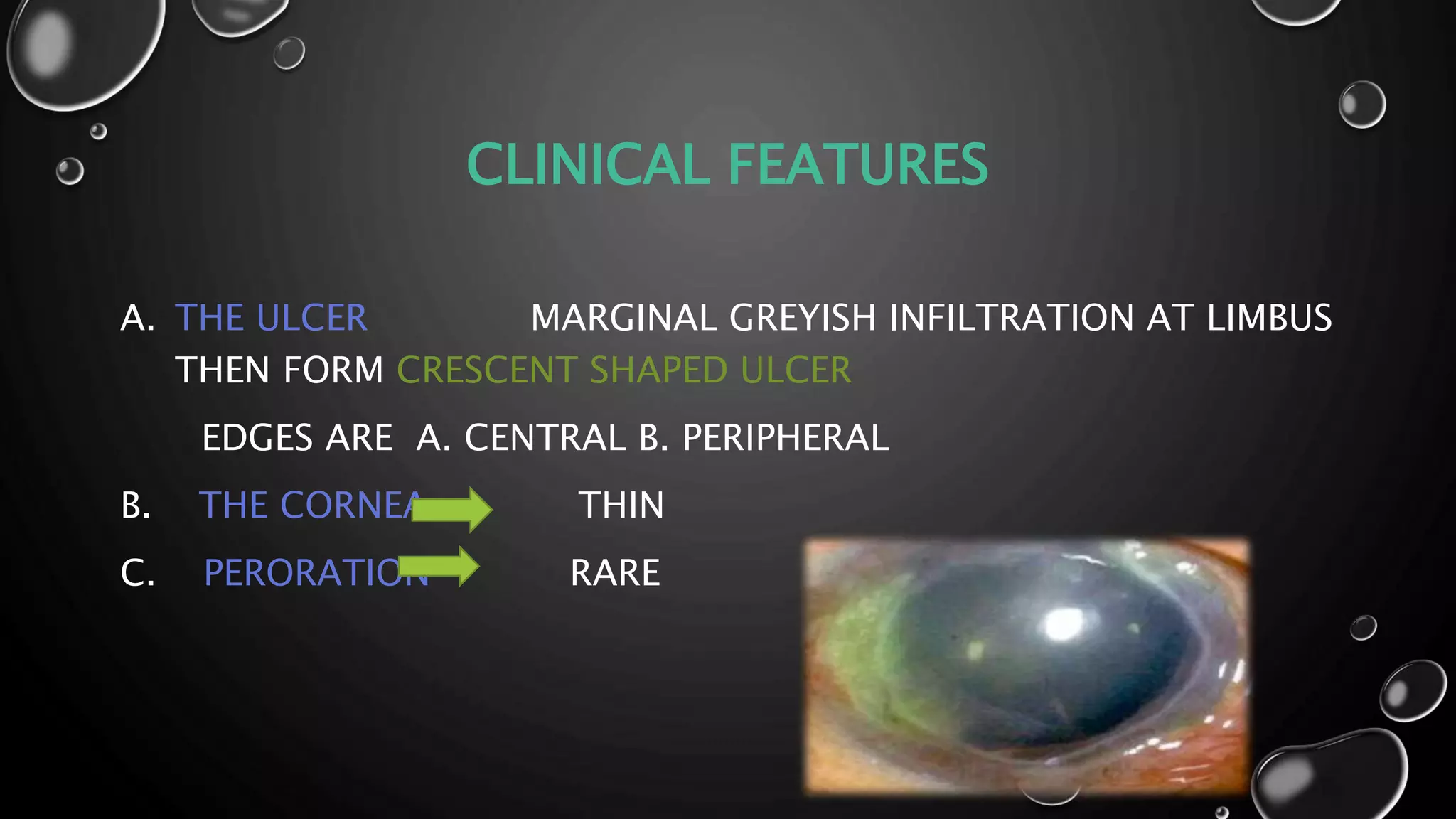 Serpiginous corneal ulcers | PPTX