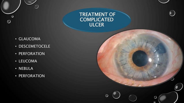Serpiginous corneal ulcers | PPTX