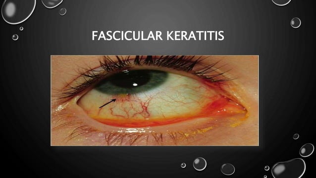 Serpiginous corneal ulcers | PPTX