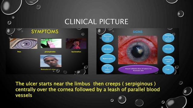 Serpiginous corneal ulcers | PPTX