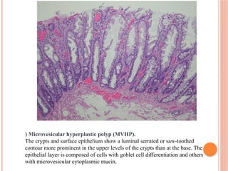 serrated lesion of colon and rectum-1.pptx