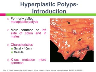 Hyperplastic Polyp Sawtooth