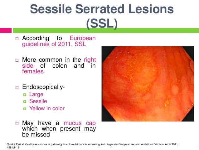 Serrated lesions of colon and rectum