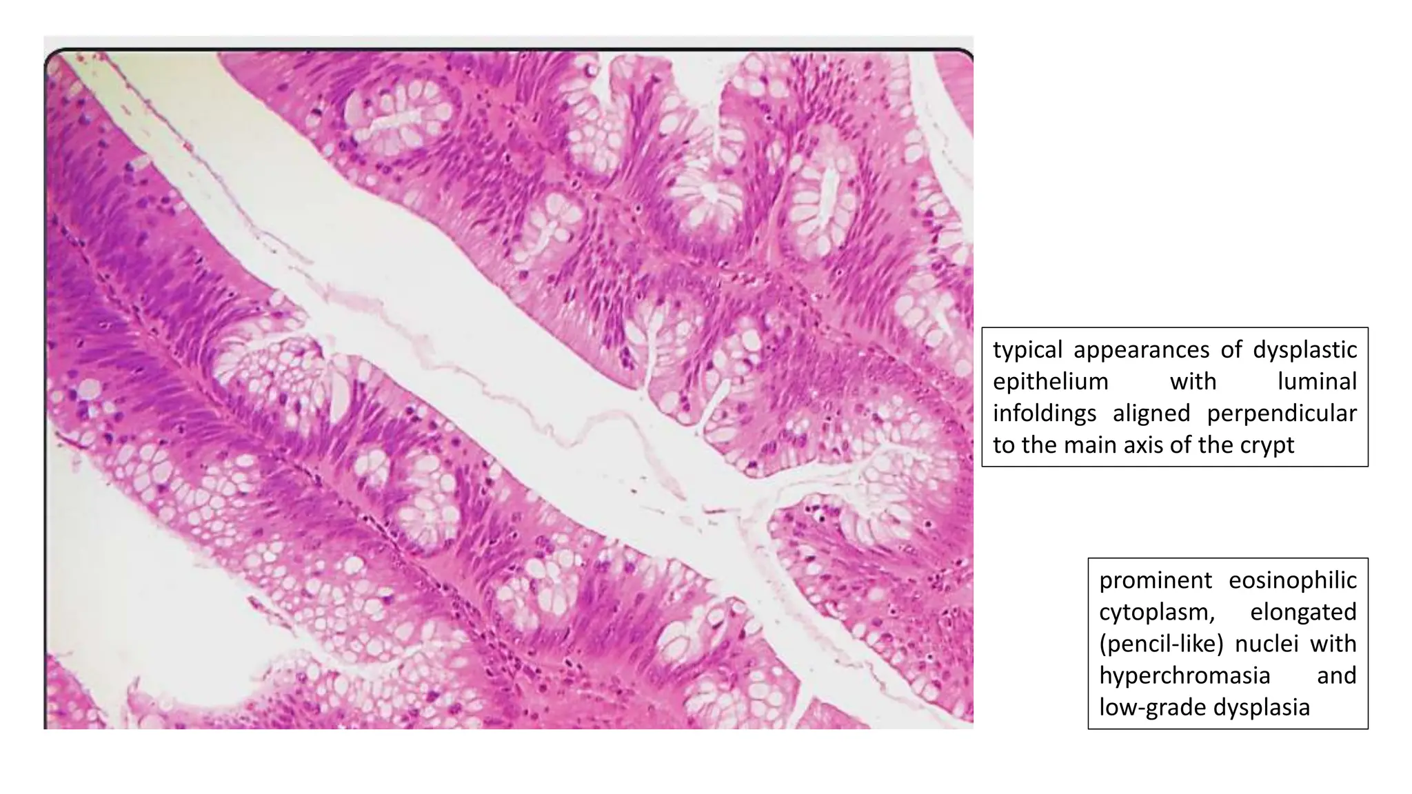 SERRATED LESIONS OF INTESTINE GI tract.pptx | Digestive Disorders ...