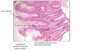 SERRATED LESIONS OF INTESTINE GI tract.pptx | Digestive Disorders ...