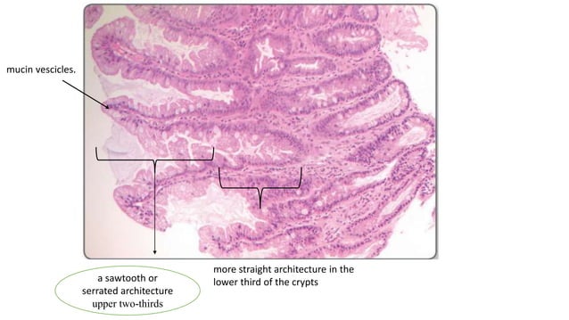 SERRATED LESIONS OF INTESTINE GI tract.pptx
