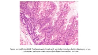 SERRATED LESIONS OF INTESTINE GI tract.pptx | Digestive Disorders ...