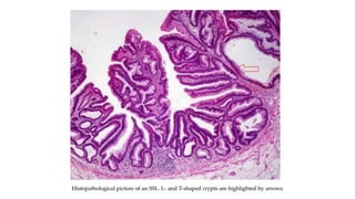 SERRATED LESIONS OF INTESTINE GI tract.pptx