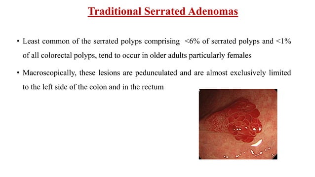 SERRATED LESIONS OF INTESTINE GI tract.pptx