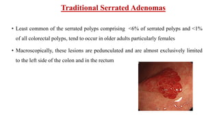 SERRATED LESIONS OF INTESTINE.pptx.G I T | PPTX