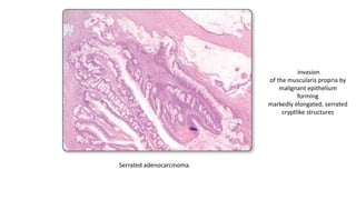 SERRATED LESIONS OF INTESTINE.pptx.G I T | PPTX