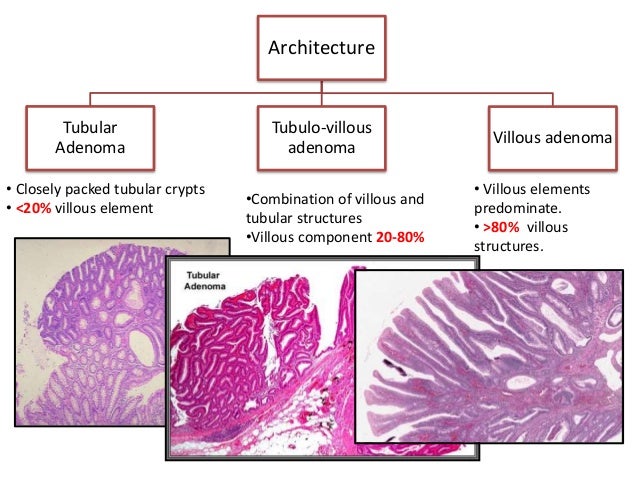 Serrated Pathway to colorectal carcinoma