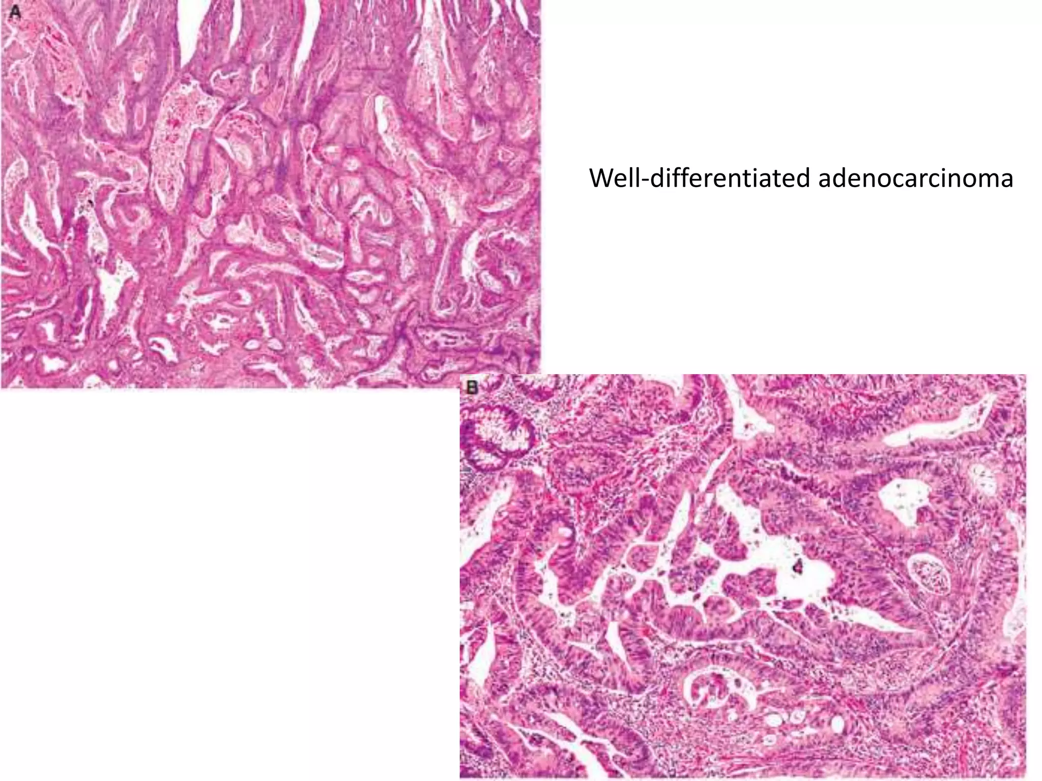 Serrated pathway to colorectal neoplasia | PPTX