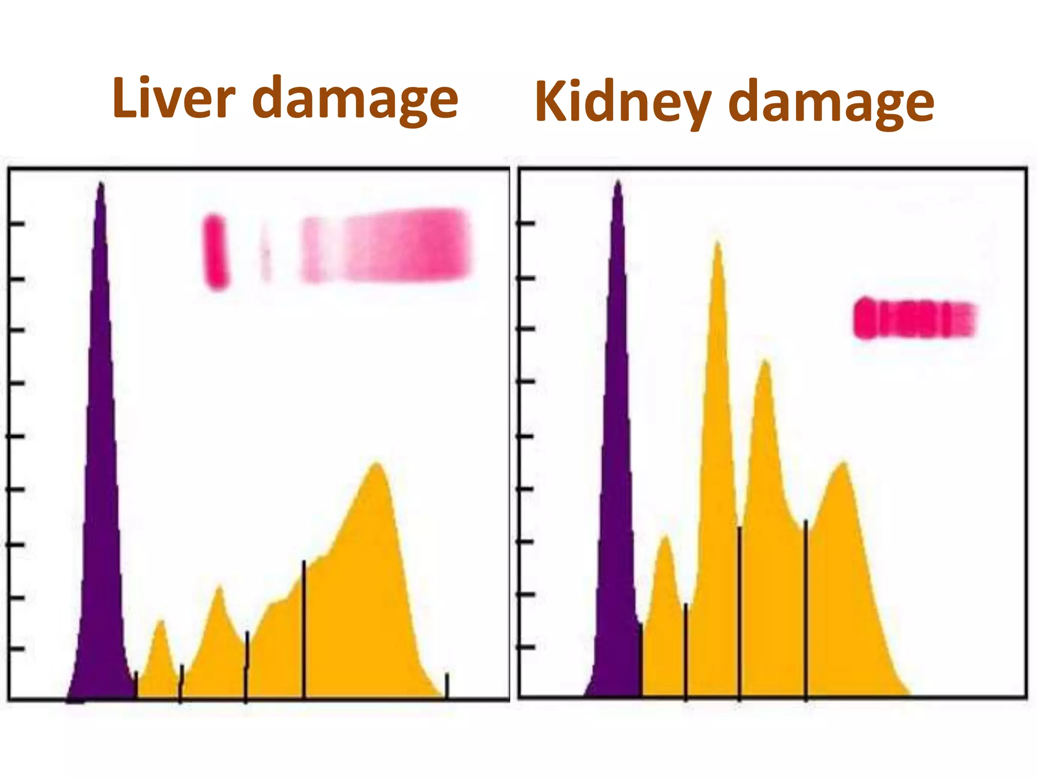 Serum protein analysis and ag ratio | PPTX