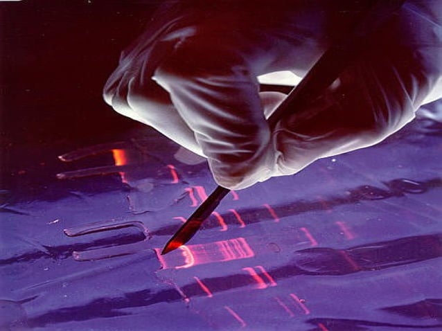 Serum protein electrophoresis & their clinical importance | PPT