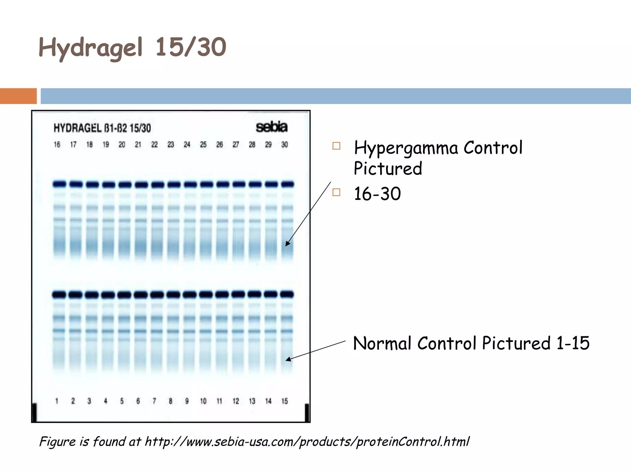 Serum protein electrophpresis | PPT