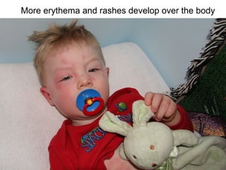 Serum sickness | PPT