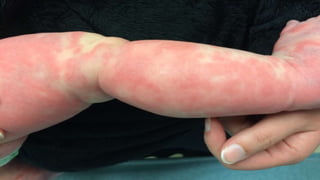 Serum sickness | PPTX