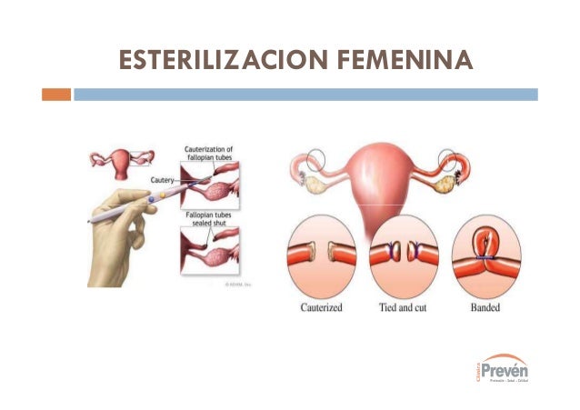 Servicio De Planificación Familiar Y Metodos Anticonceptivos Prevén